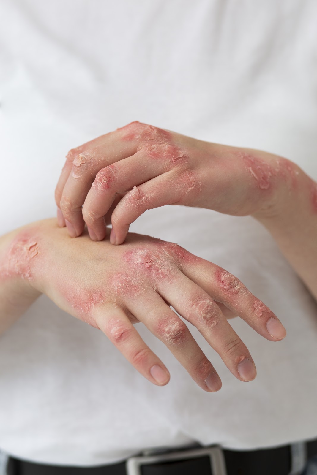 Phototherapy for Best Psoriasis Treatment - Dr Skin