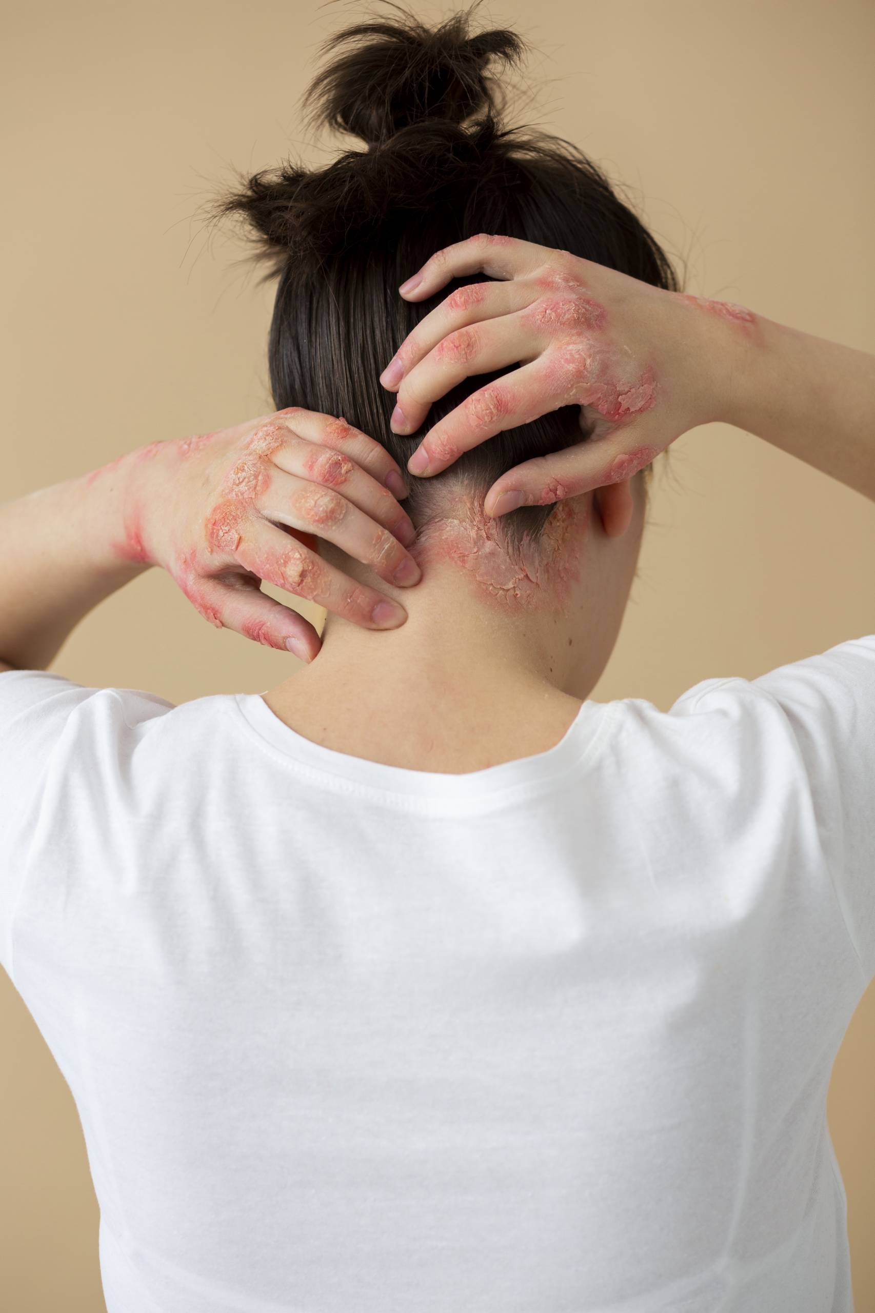 Occlusion Therapy for Scalp Psoriasis: A Targeted Solution at Dr. Skin ...