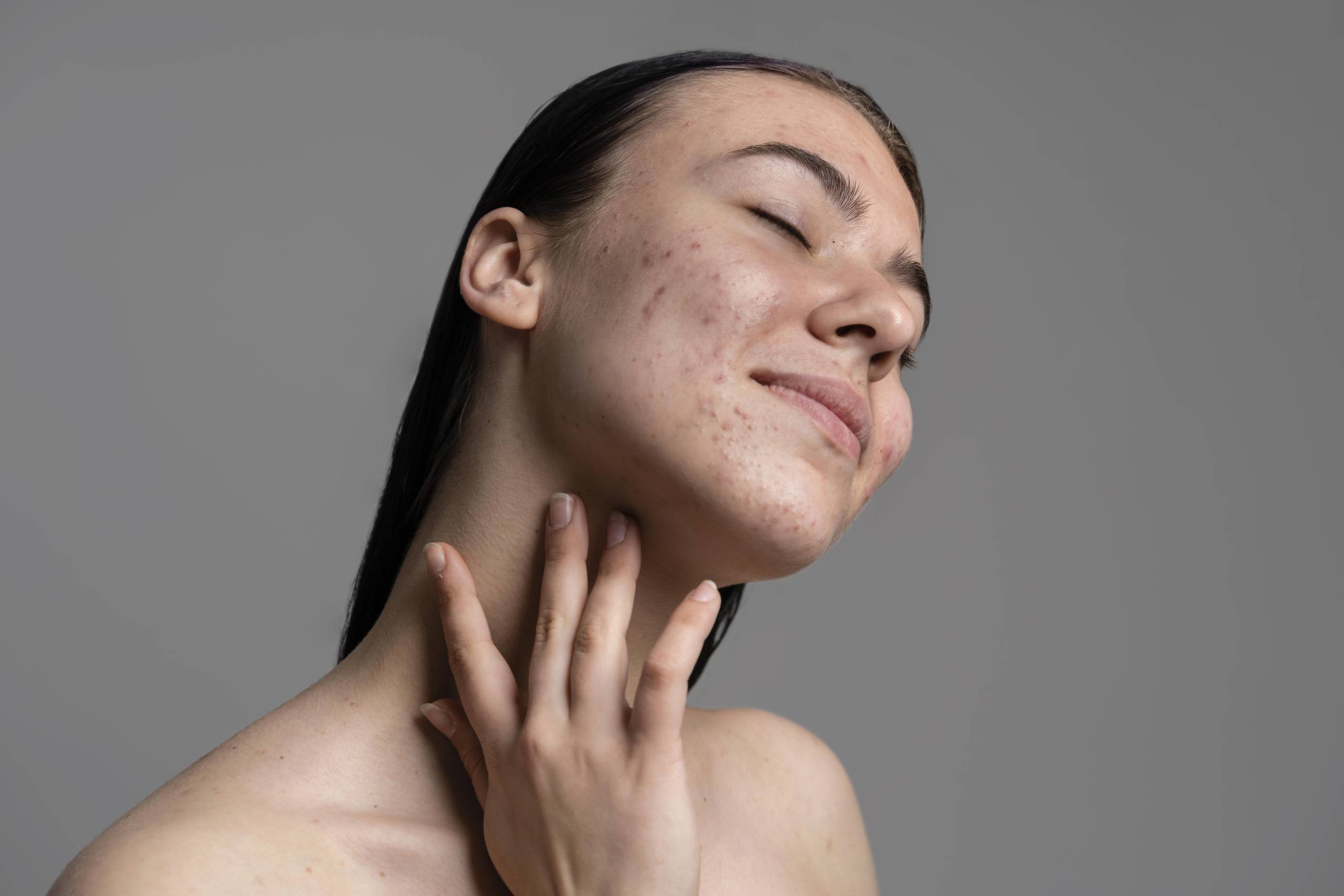 Acne and Acne scars: What is the Best Treatment for Acne? - Dr Skin