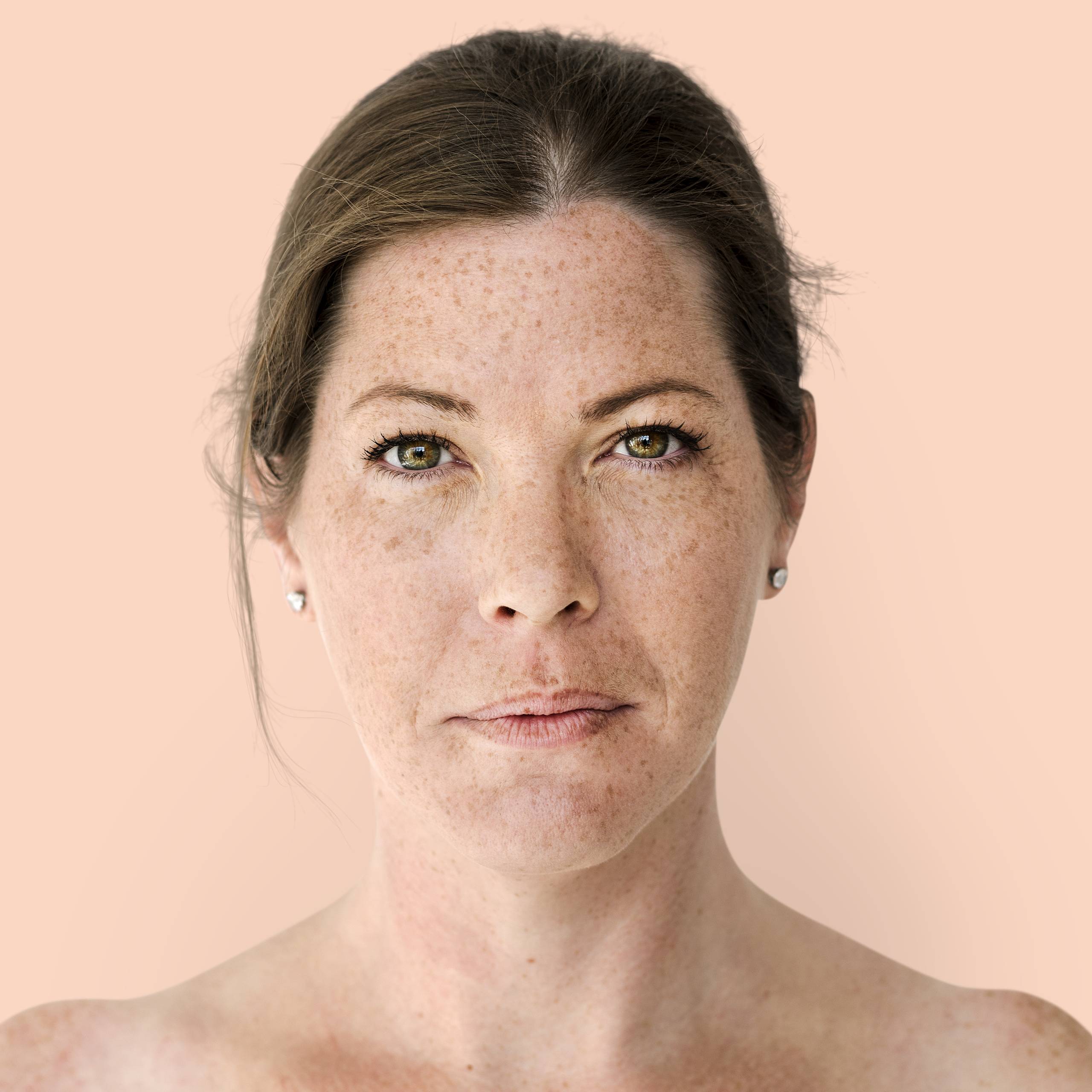 Sun Protection: A Vital Step in Melasma Treatment - Dr Skin