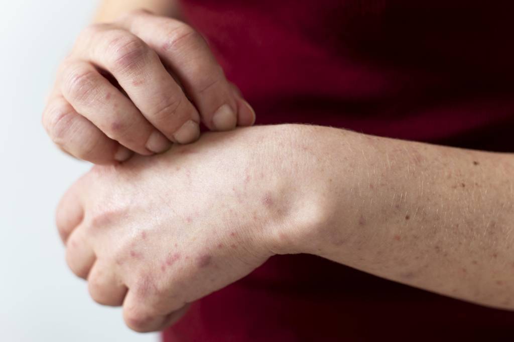 Autologous Serum Therapy for Eczema Treatment at Dr. Skin Clinic - Dr Skin