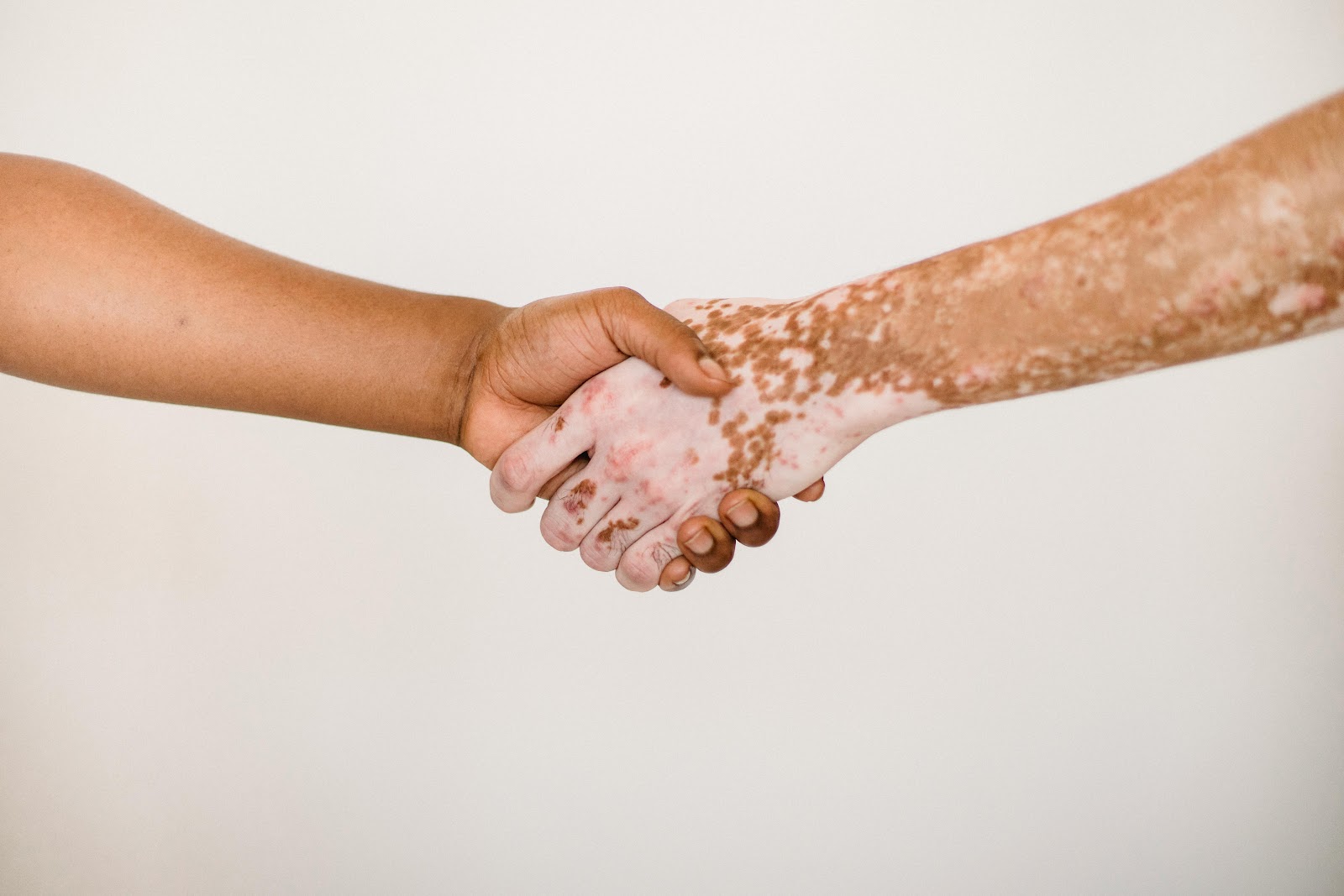 Understanding Vitiligo: Types, Symptoms and Treatment Options - Dr Skin